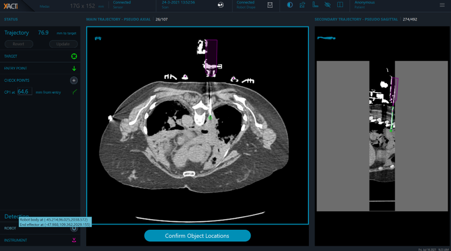 Robotic Planning, Insertion and Steering for a Paraspinal Mass - XACT