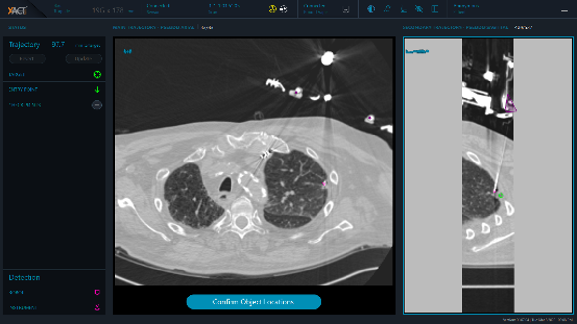 Small Lung Lesion Procedure - XACT