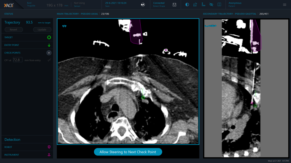 Left Lung Apex Lesion - XACT