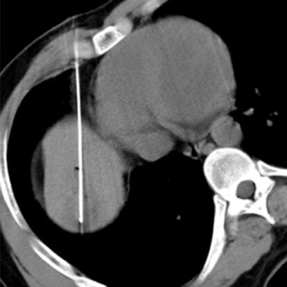 Interventional Percutaneous Procedures - XACT Robotics