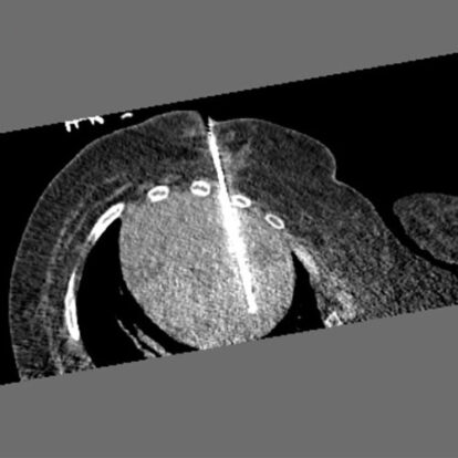 Interventional Percutaneous Procedures - XACT Robotics